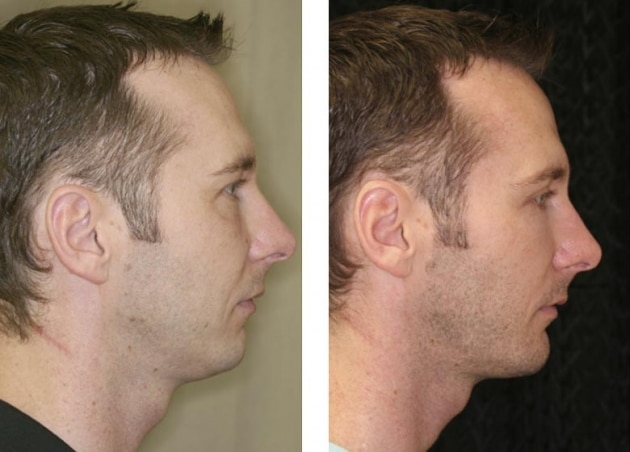 Genioplastia Marruecos : precio barato para la cirugía de mentón